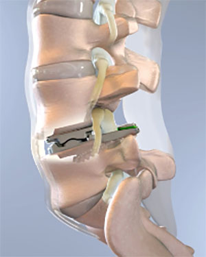 CSMO Completes First Lumbar Total Joint Replacement in the US