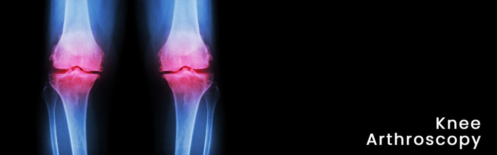 Knee Arthroscopy