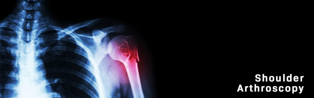 Shoulder Arthroscopy