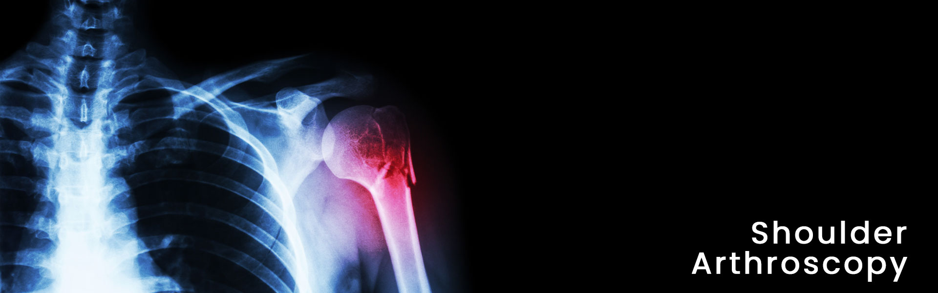 Shoulder Arthroscopy