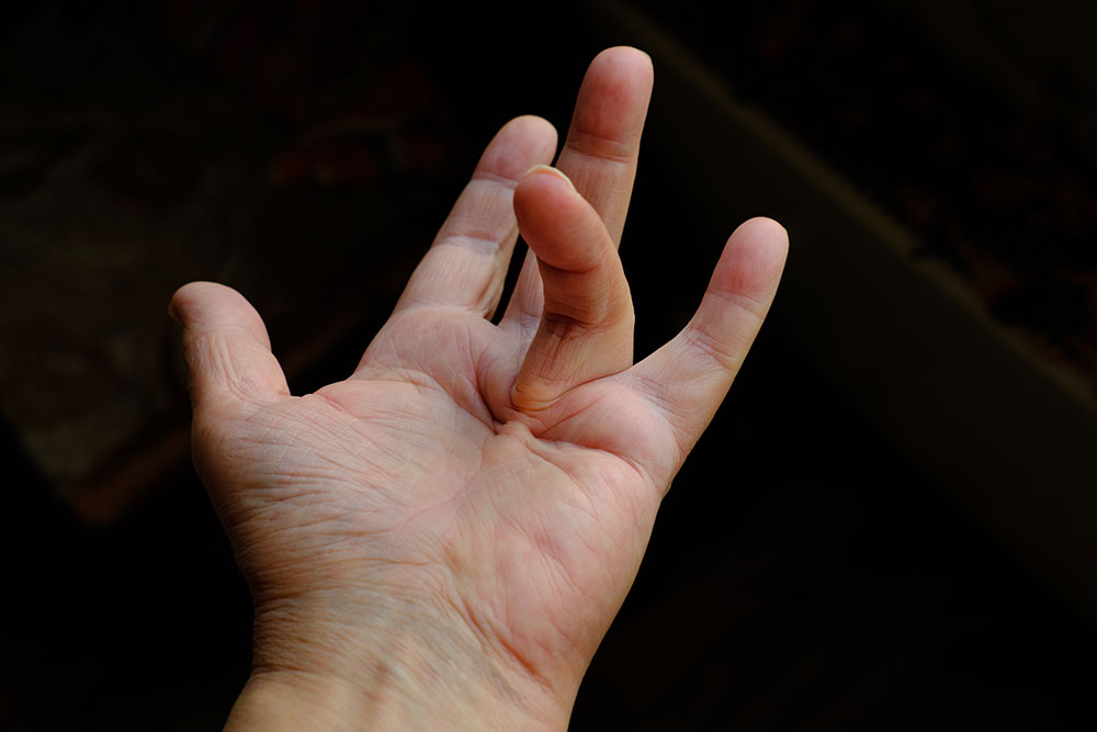 Dupuytren's Contracture